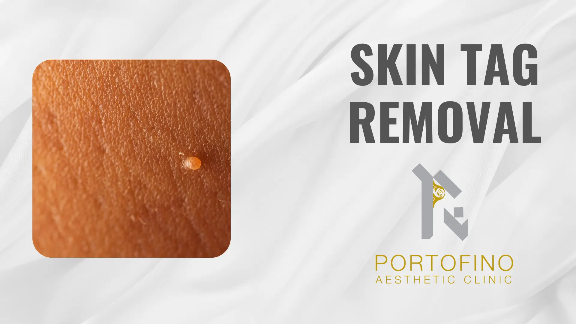 Best Skin Tag Removal In Dubai | Black Tag Removal Dubai