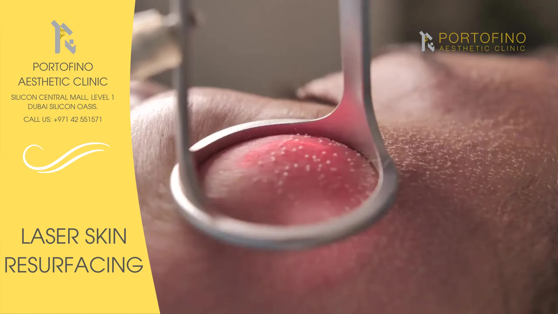 Laser Skin Resurfacing with CO2 Fractional Laser - Dubai Silicon Oasis ...